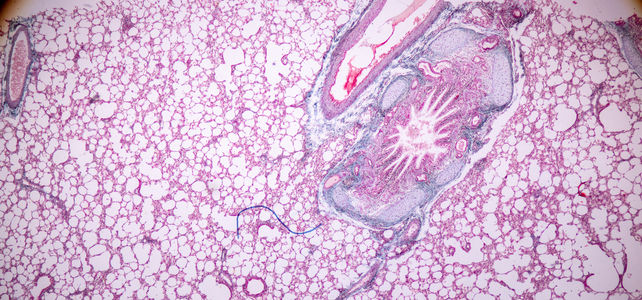 ES-SCLC: New pembrolizumab KEYNOTE-604 trial data